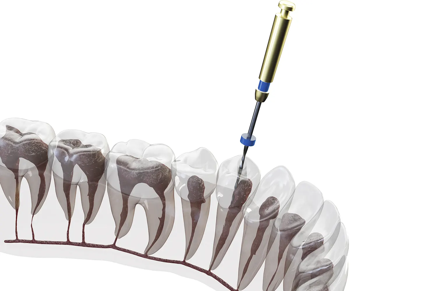 How Many Times Can a Root Canal Retreat? | Premier Endodontics of SouthPark